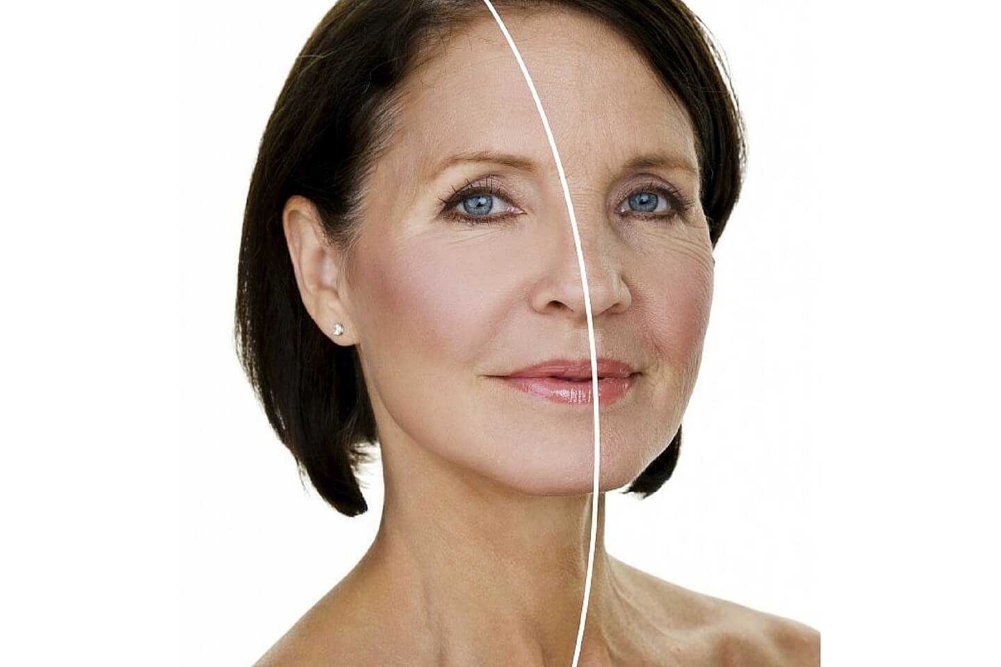 Ultherapy – Ameliyatsız Yüz ve Boyun Germe - KBB Uzmanı Ultherapy – Ameliyatsız Yüz ve Boyun Germe - KBB Uzmanı